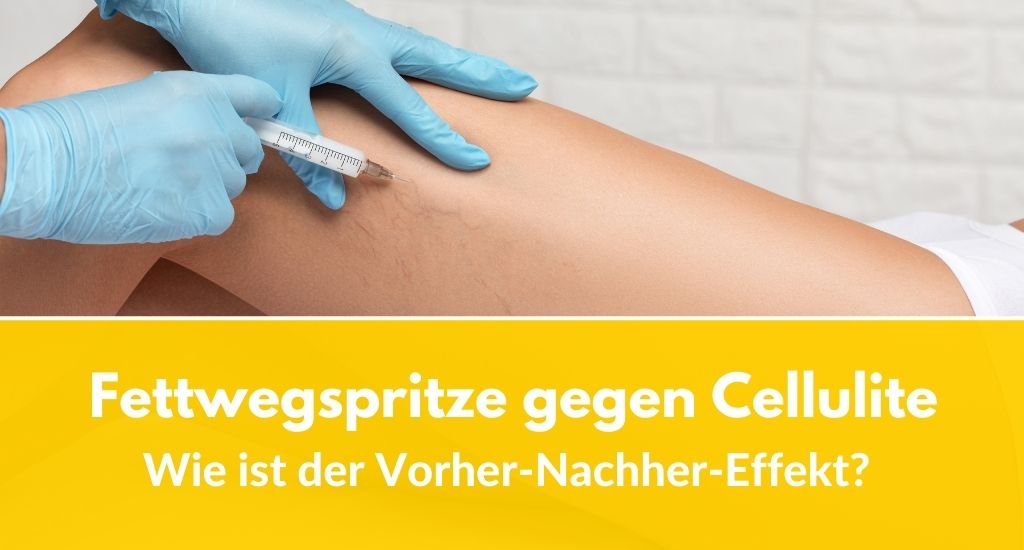 Fettwegspritze gegen Cellulite: Wie ist der Vorher-Nachher-Effekt? – Senfsalbe