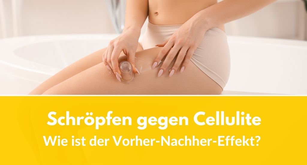 Schröpfen gegen Cellulite: Wie ist der Vorher-Nachher-Effekt? – Senfsalbe