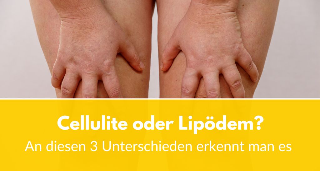 Cellulite oder Lipödem: Erkennbar an diesen 3 Unterschieden! – Senfsalbe